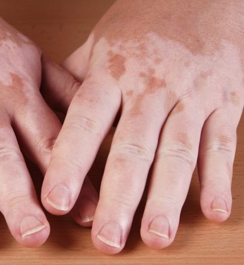 VITILIGO | Dr Mohamed Sacoor